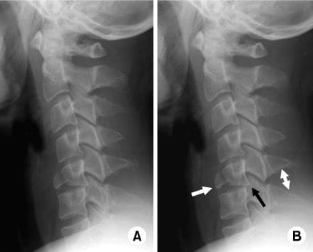 Imaging Diagnostics For Flexion Teardrop Fractures El Paso TX Doctor Imaging Diagnostics For Flexion Teardrop Fractures El Paso TX Doctor