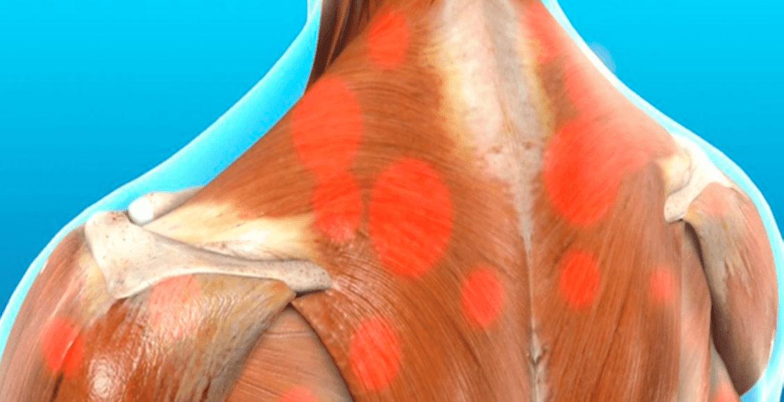 Myofascial Trigger Pain Affecting The Trapezius Muscle - El Paso, TX ...